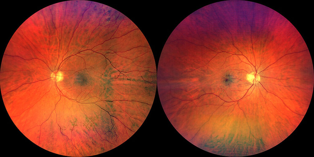 Understanding Glaucoma Test Results | Southwest Eye