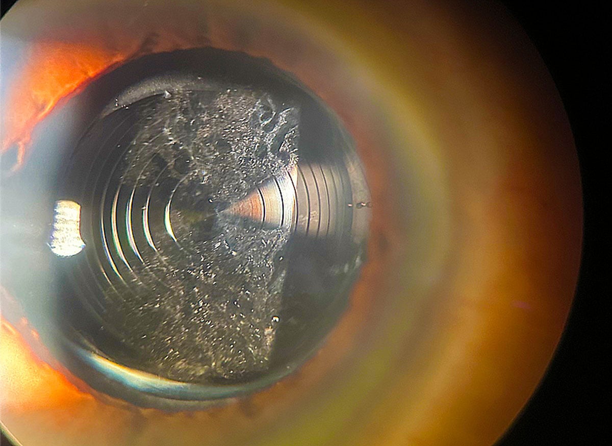 Cloudy Vision After Cataract Surgery: Causes and Fixes